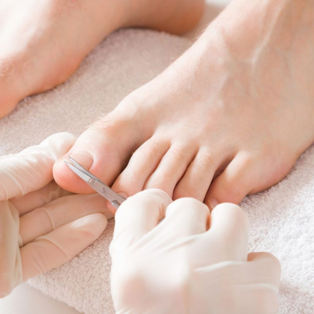 Ingrown Toenail Treatment - Advanced Foot Care Nurse and Wellness