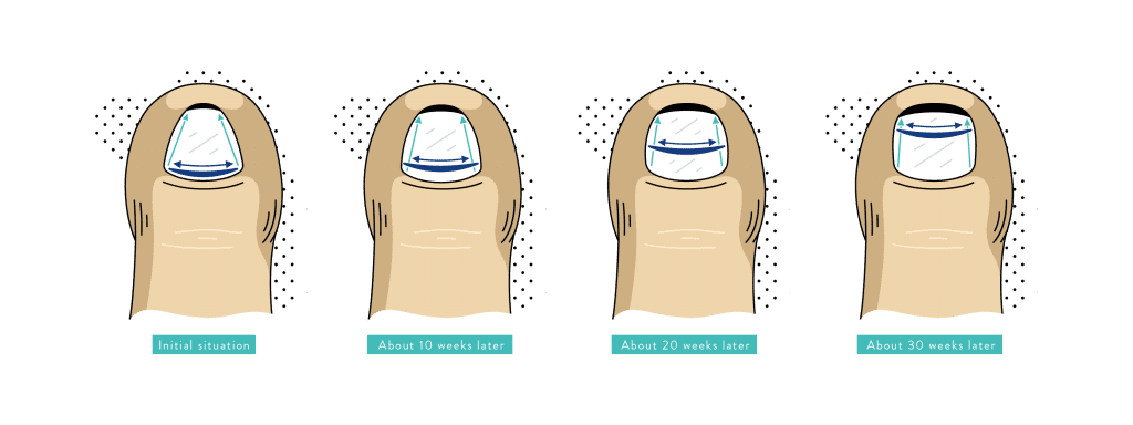 Onyfix Nail Correction System - Advanced Foot Care Nurse and Wellness