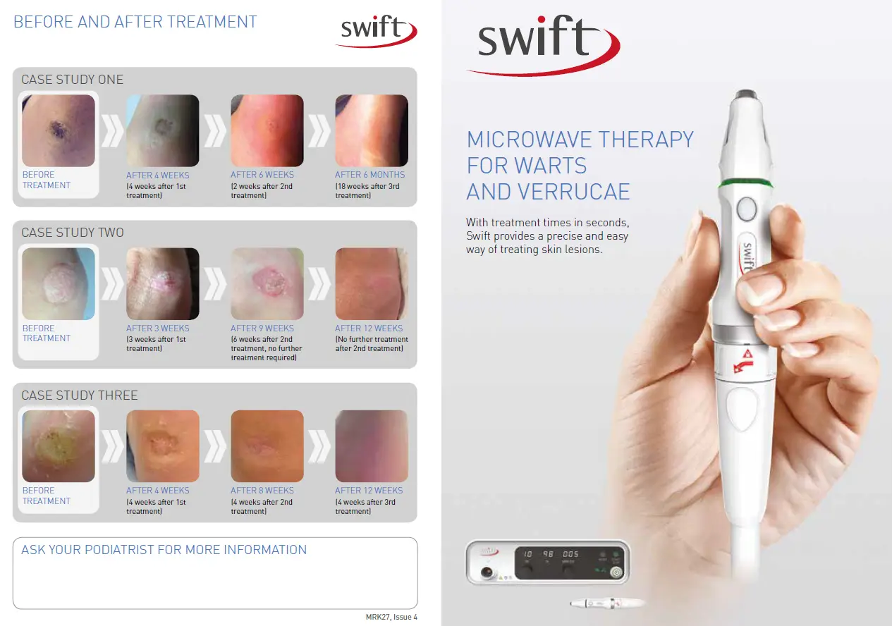The Breakthrough of Swift Microwave Treatment in Wart Removal